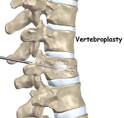 Vertebroplasty & Kyphoplasty - Spinomax