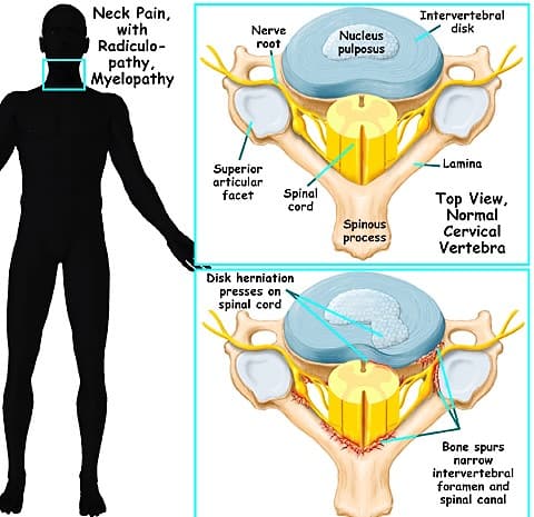 Neck Pain - Spinomax