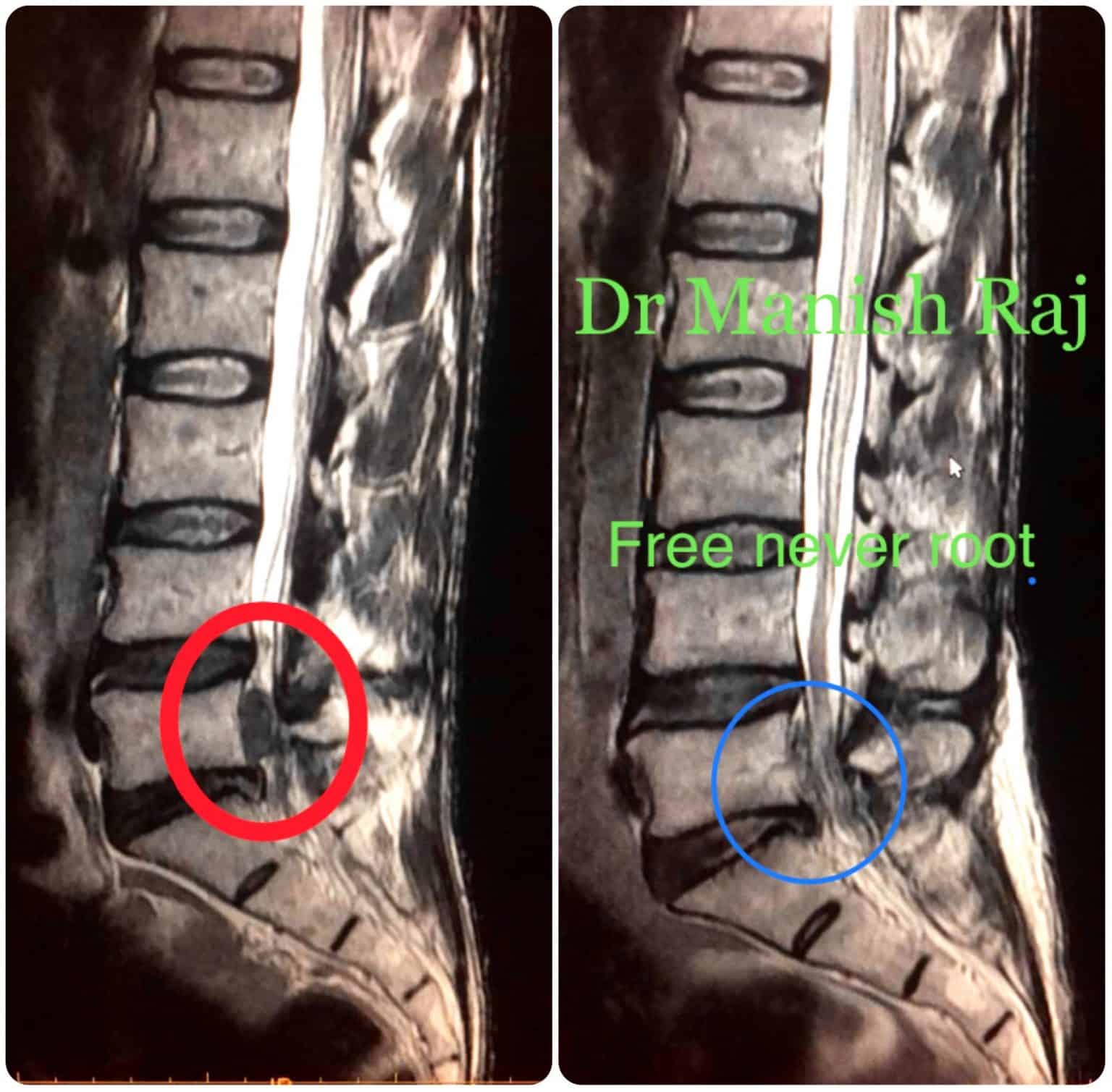 Treatment of sequestrated Disc- Cauda equina syndrome (TCS-3) - Spinomax